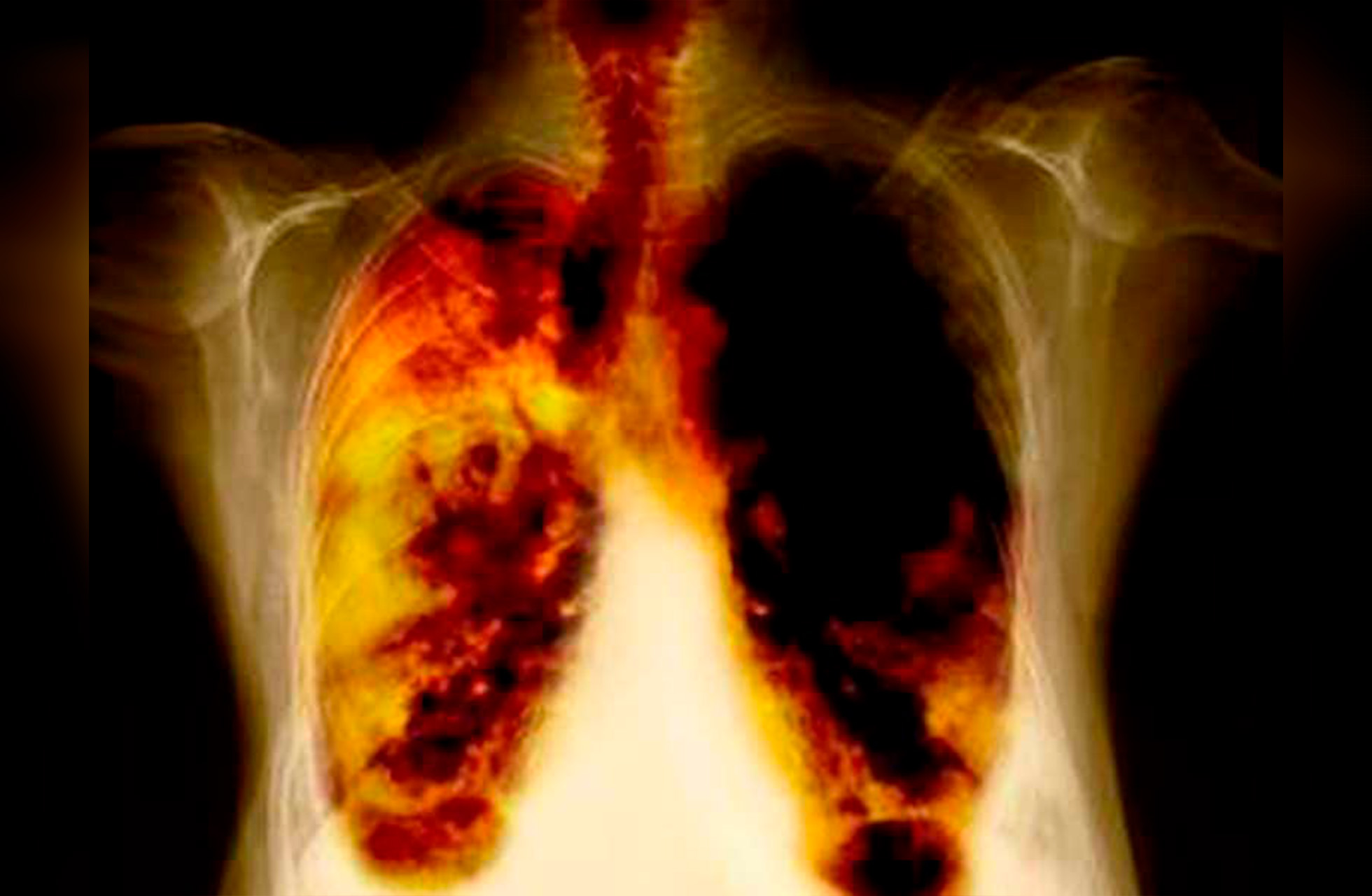 Descubren 'el talón de Aquiles' del cáncer de pulmón | Aristegui Noticias