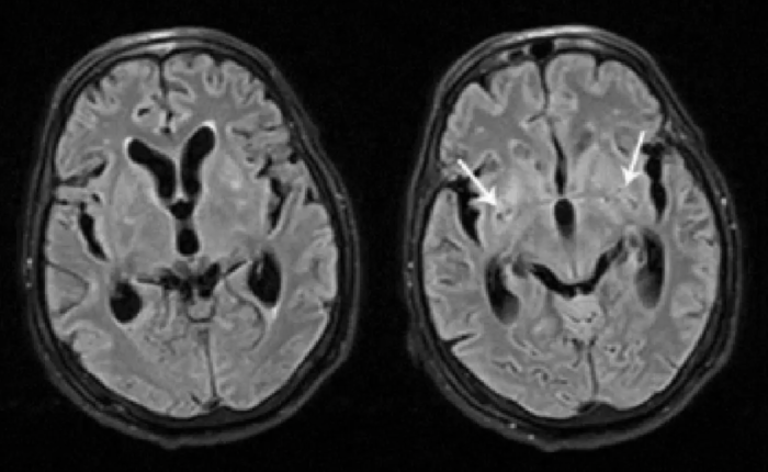 Cofepris descarta hongo en medicamentos relacionados al brote de ...